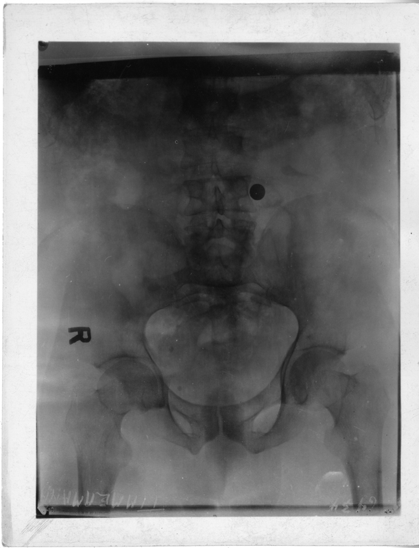 X-Ray Scan From Crime Scene File | Harry S. Truman